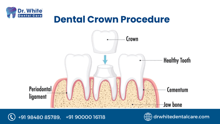 Complete Guide to Dental Glue for Crowns|Best Clinic 2026