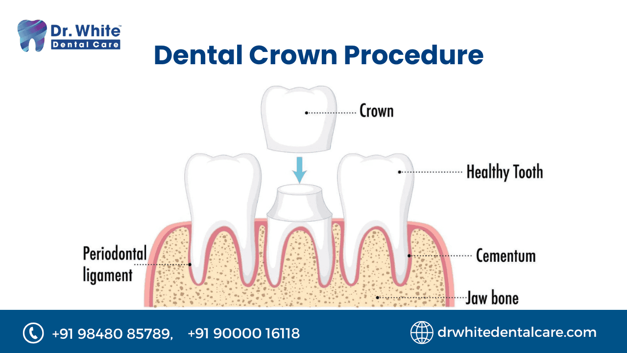 Temporary Crown Cement Cement For Crowns & Bridges - 7g Tube For DIY ...