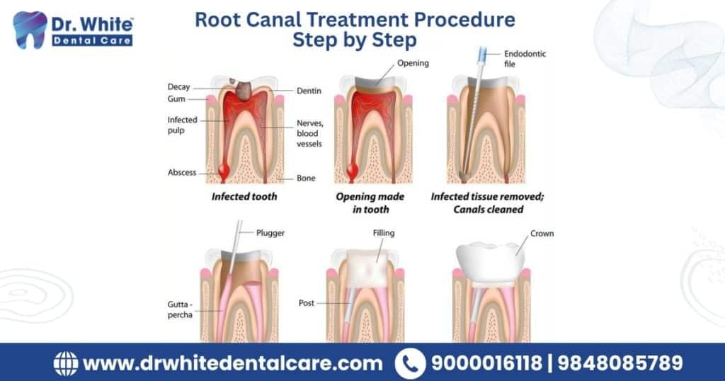 Root Canal Treatment Procedure Step by Step Guide 2026